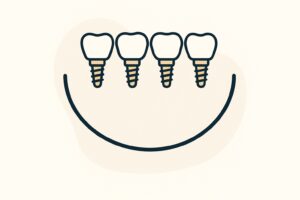What Does Per Arch Mean In Dental Implants
